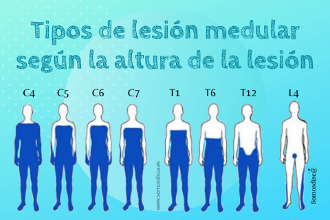 Lesión medular, cuales son sus tipos como afecta. - Somosdisc@